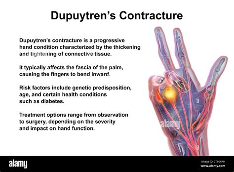 A 3d Medical Illustration Displaying A Patients Hand With Dupuytrens Contracture Emphasizing