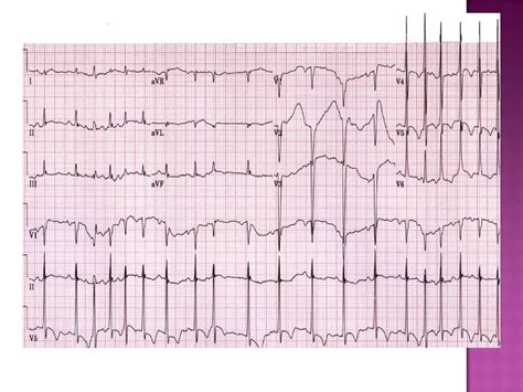 What Is Multifocal Atrial Tachycardia