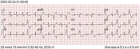 68 Yom Syncopefall Rekgs