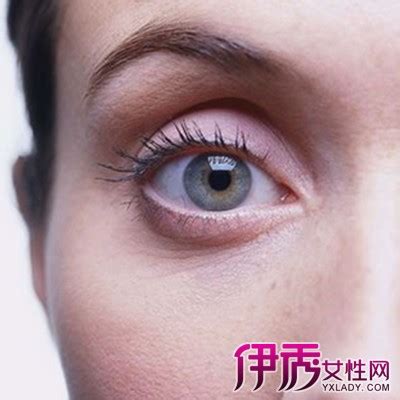 角膜炎什么症状 角膜炎的症状及治疗 随意云