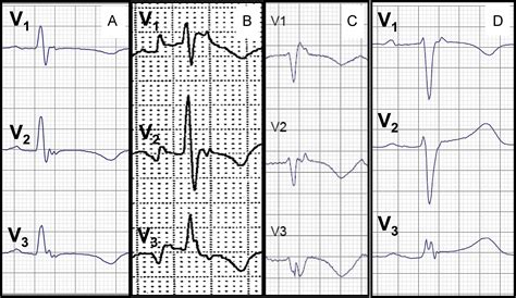 High Interobserver Variability In The Assessment Of Epsilon Waves