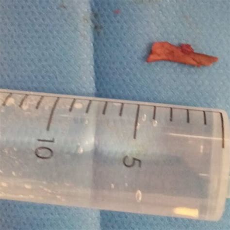 Foreign Body With Sharp Bone Fragment Type About 4 Cm Long Download Scientific Diagram