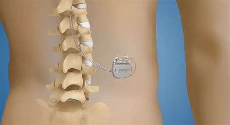 Spinal Cord Stimulation In Houston Nw Surgery