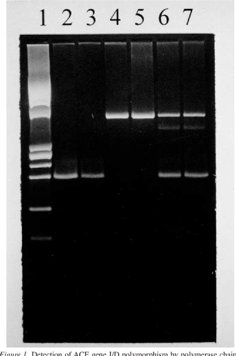 Figure 1 From Angiotensin Converting Enzyme Gene Insertion Deletion Polymorphism Is Associated
