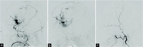 Cerebral Angiogram On Admission And After Preoperative Embolization