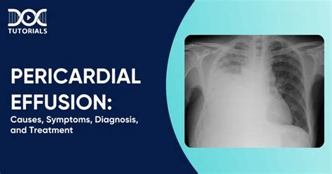 Pericardial Effusion Causes Symptoms Diagnosis And Treatment