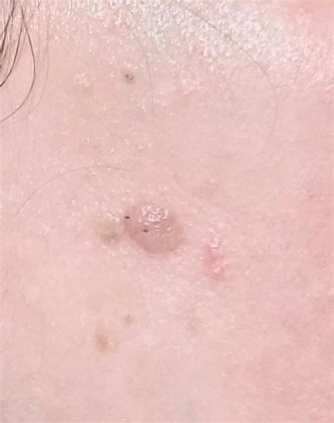 Bump Growing Quickly On Cheek Rdermatologyquestions
