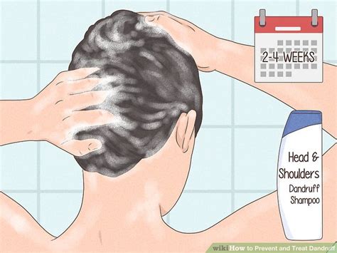 Ways To Prevent And Treat Dandruff WikiHow