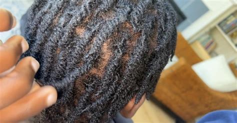 Interlocks Still Tight At Root 3 Months Later What Can I Do I Want To