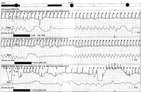 Neonatal Electrocardiogram From Telemetry Strip Demonstrating Atrial Download Scientific