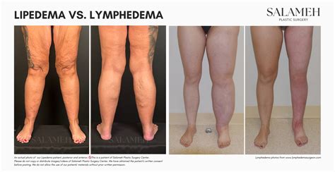 Lipedema Vs Lymphedema Key Differences You Should Know