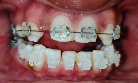 Comparing Self Ligating Braces To Traditional Braces