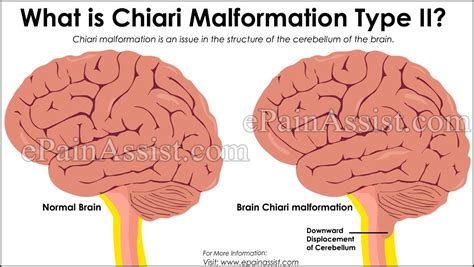 What Is Chiari Malformation Type Ii How Does It Affect Your Body And
