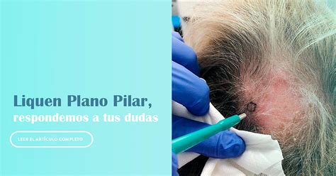 Liquen Plano Todo Lo Que Debes Conocer Sobre él Meyer And Alcaide