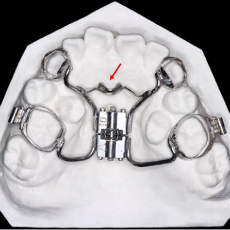 Pdf Maxillary Anterior Segmental Distraction Osteogenesis To Correct