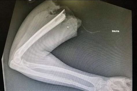 Ulna Fracture R Neverbrokeabone