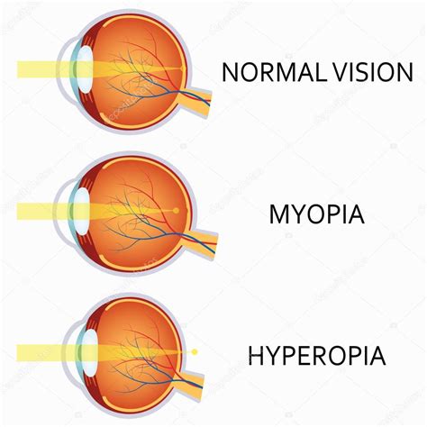 Optical Human Eye Defects Myopia And Hyperopia