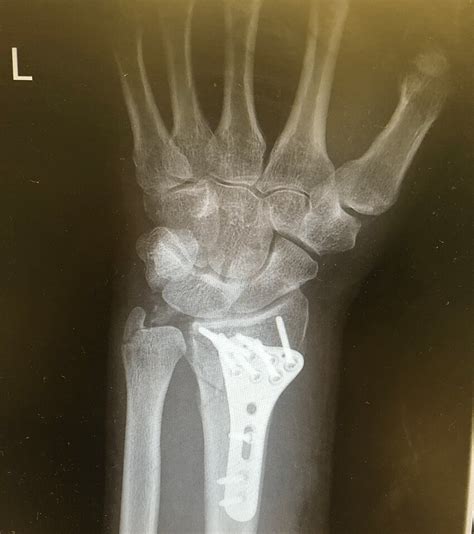 Open Reduction Internal Fixation