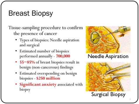 Ppt Bayesian Network For Predicting Invasive And In Situ Breast