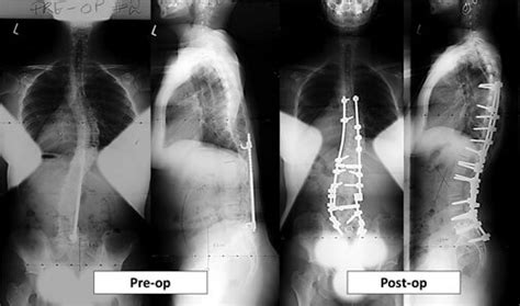 Flatback Syndrome Scoliosis And Spine Associates