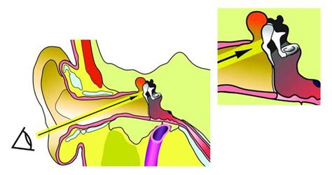 Endoscopic Diagnosis And Follow Up Of Retraction Pockets And