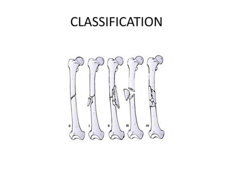 Comminuted Segmental Fracture Of Femur Shaft