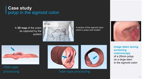 Physician Reviewof Clinical Images 13 Image Taken During Colonoscopy Of