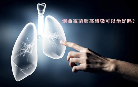 解答烟曲霉菌肺部感染能治好吗伏立康唑正确服用方法要牢记 哔哩哔哩