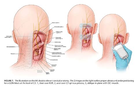 Can A Tens Unit Help Occipital Neuralgia At Samuel Austral Blog