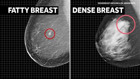 Normal Mammogram Dense Tissue