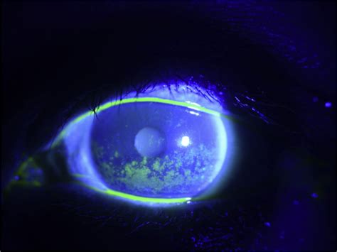 Recurrent Corneal Erosion