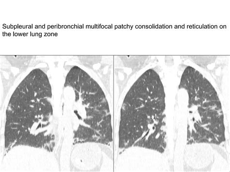 Diffuse Alveolar Damage PPT