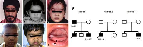 Figure 1 From Hyper Ige Syndrome With A Novel Stat3 Mutation A Single