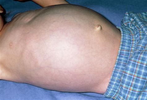 Edema Abdomen