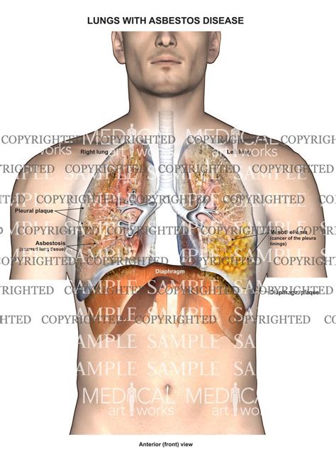 Lungs With Asbestos Disease Medical Art Works