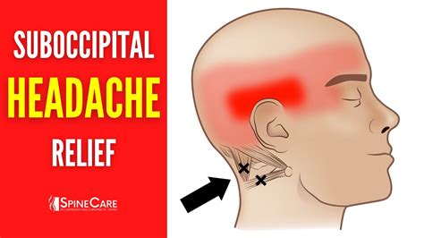 How To Release Tight Suboccipital Muscles Headache Relief In Seconds