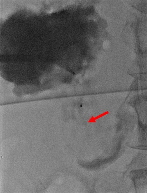 Post Amplatzer Vascular Plug Deployment Abscessogram Demonstrating