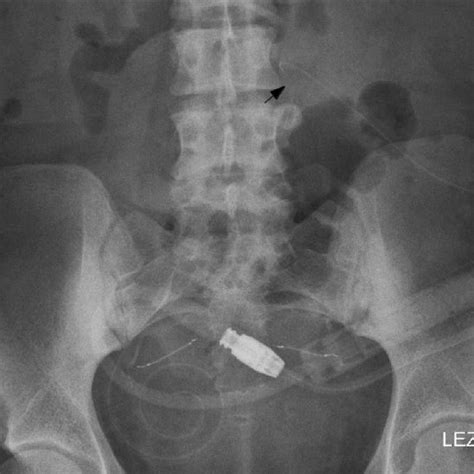 PDF Exit Site Infection And Acute Peritonitis Due To Peritoneal Dialysis Catheter Rupture