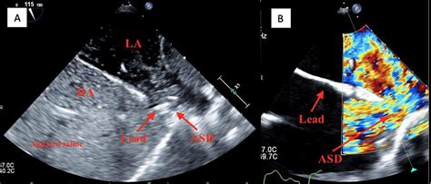 A Rare Case Of Sinus Venosus Atrial Septal Defect Malpositioned Right Atrial Pacemaker Lead In