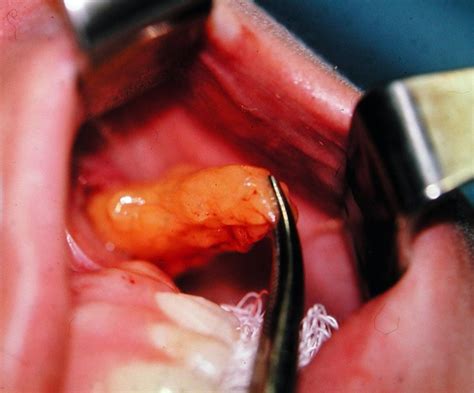 Buccal Lipectomy Intraop Explore Plastic Surgery