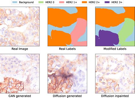 Improved Her2 Tumor Segmentation With Subtype Balancing Using Deep Generative Networks Paper