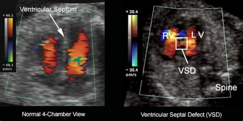 What Do The Colors Mean On Doppler Ultrasound Scan