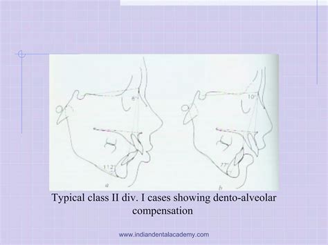 Class 2 Division 1 Malocclusions Ppt