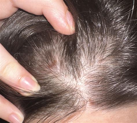 Im 23 And Have Been Picking My Scalp For Around 12 Years Noticed How Much My Hair Is Thinning