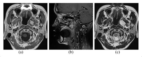 Mri Before The Operation Showed The Well Defined Mass In The Left Pps