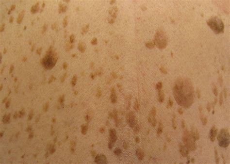 Preventing And Treating Benign Barnacles Seborrheic Keratoses On