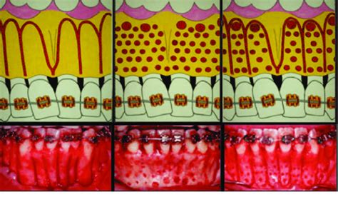 The Technique For Alveolar Decortication Is Based More Upon Cortical