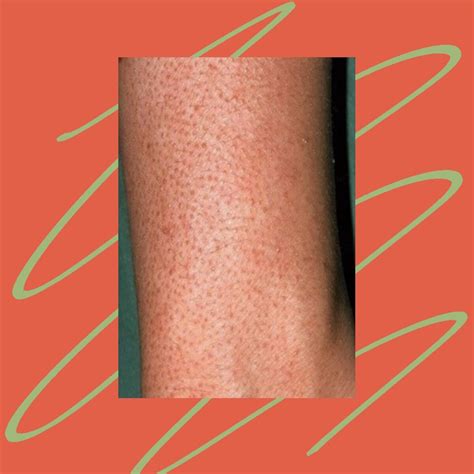 Что за красные точки на ногах и как от них избавиться Химия в твоей косметичке Дзен