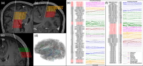 Demonstration Of The Anatomical Framework For An SEEG Exploration With Download Scientific