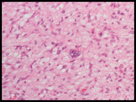 Pathological Examination Of The Resected Tumor Pathological